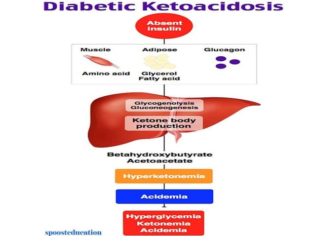 Diabetic Ketoacidosis | PPTX | Endocrine and Metabolic Diseases ...