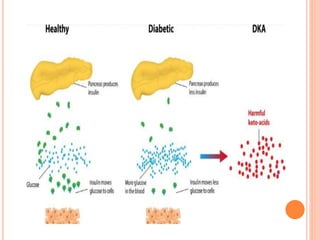 DKA for nurses | PPTX