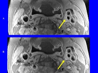 Spio mri studies by dr naghavi | PPT