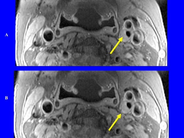 Spio mri studies by dr naghavi | PPT