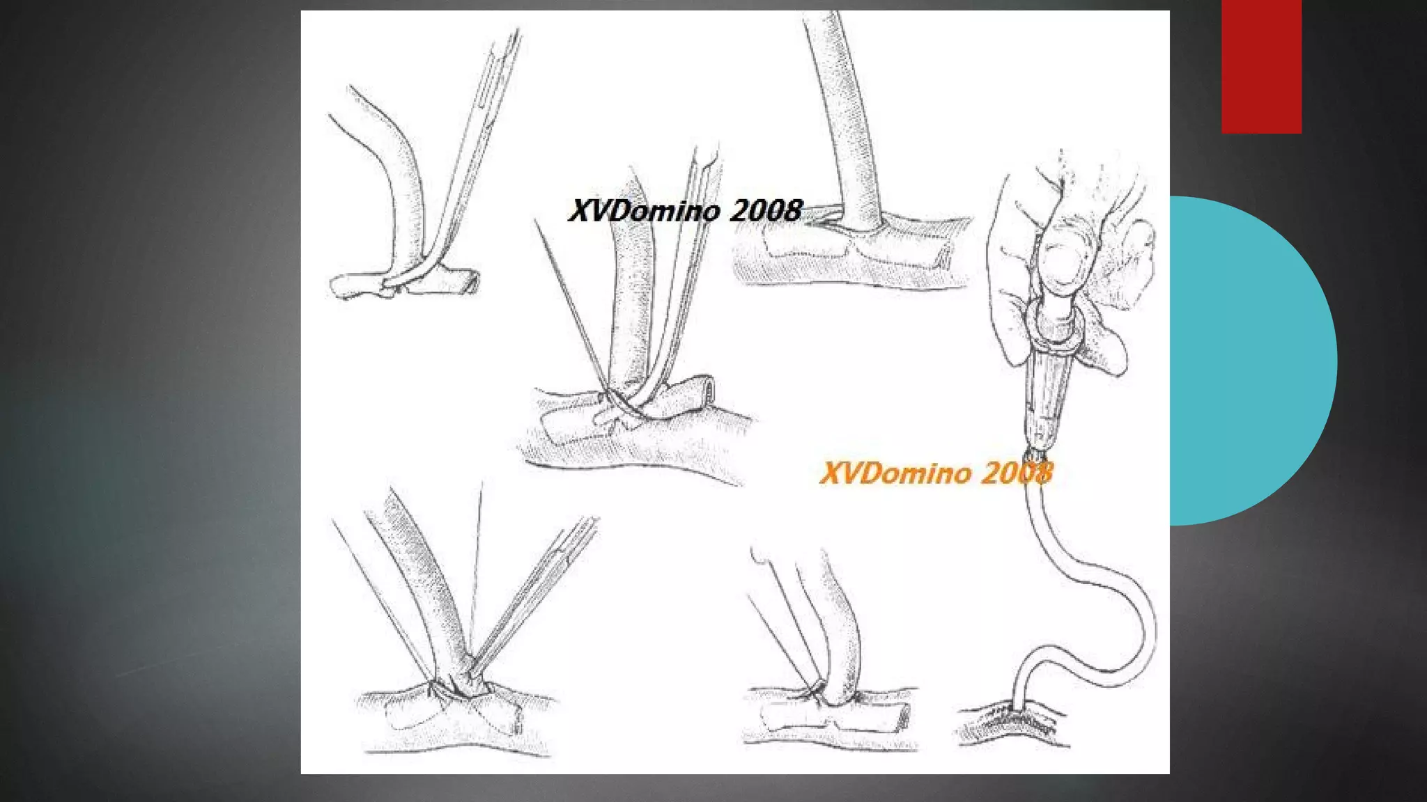 Dẫn lưu kehr | PPT