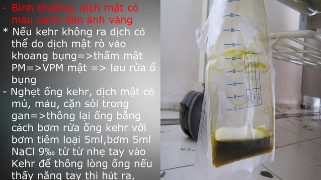 Dẫn lưu kehr | PPT