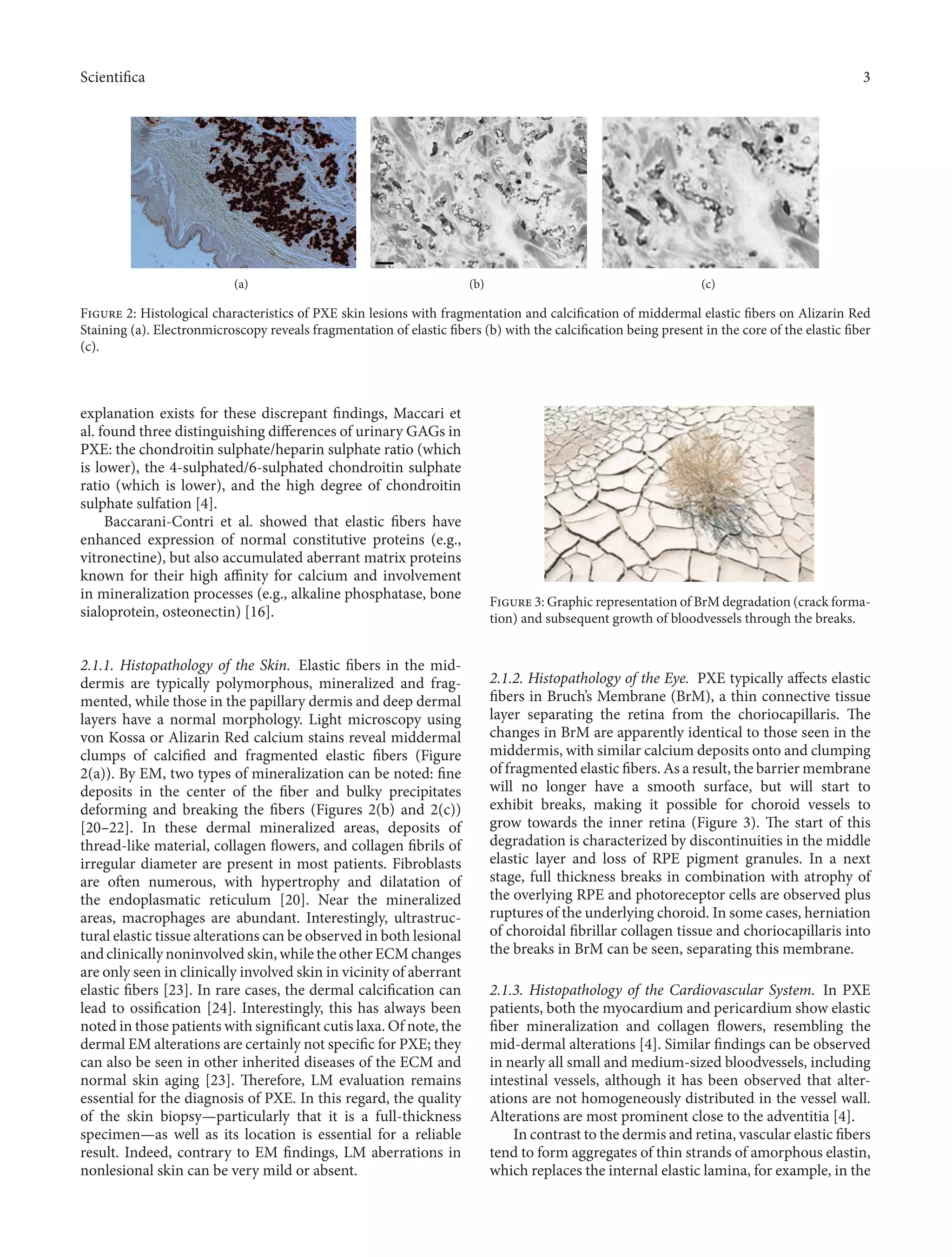 Histopathology_of_Pseudoxanthoma_Elasticum_and_Related.pdf | Blood ...