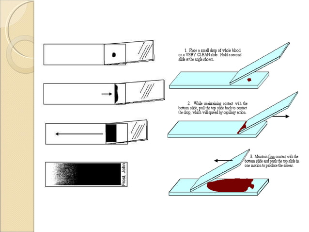 Dlc by peripheral smear comparison with automated differential | PPT