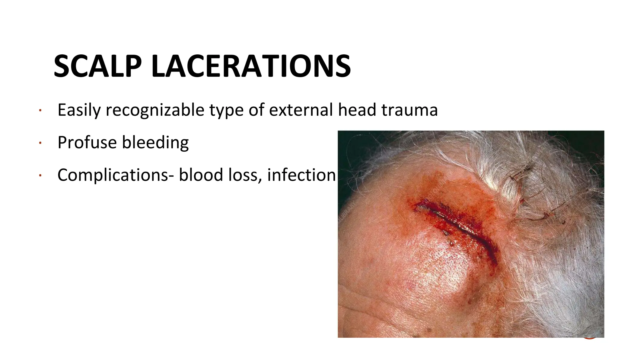 Head_injury (Traumatic Brain Injury).pptx
