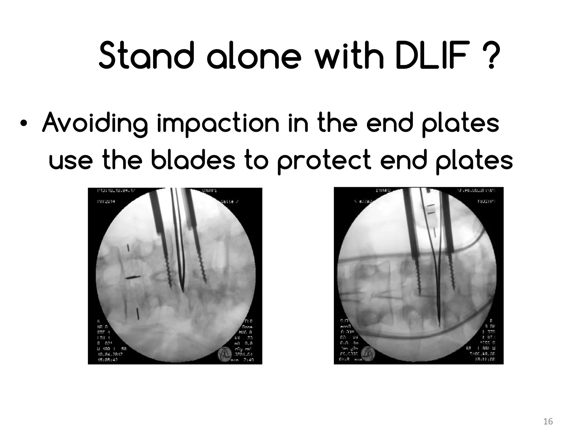 Lateral Lumbar Interbody Fusion : DLIF, XLIF with Lateral Fixation in ...