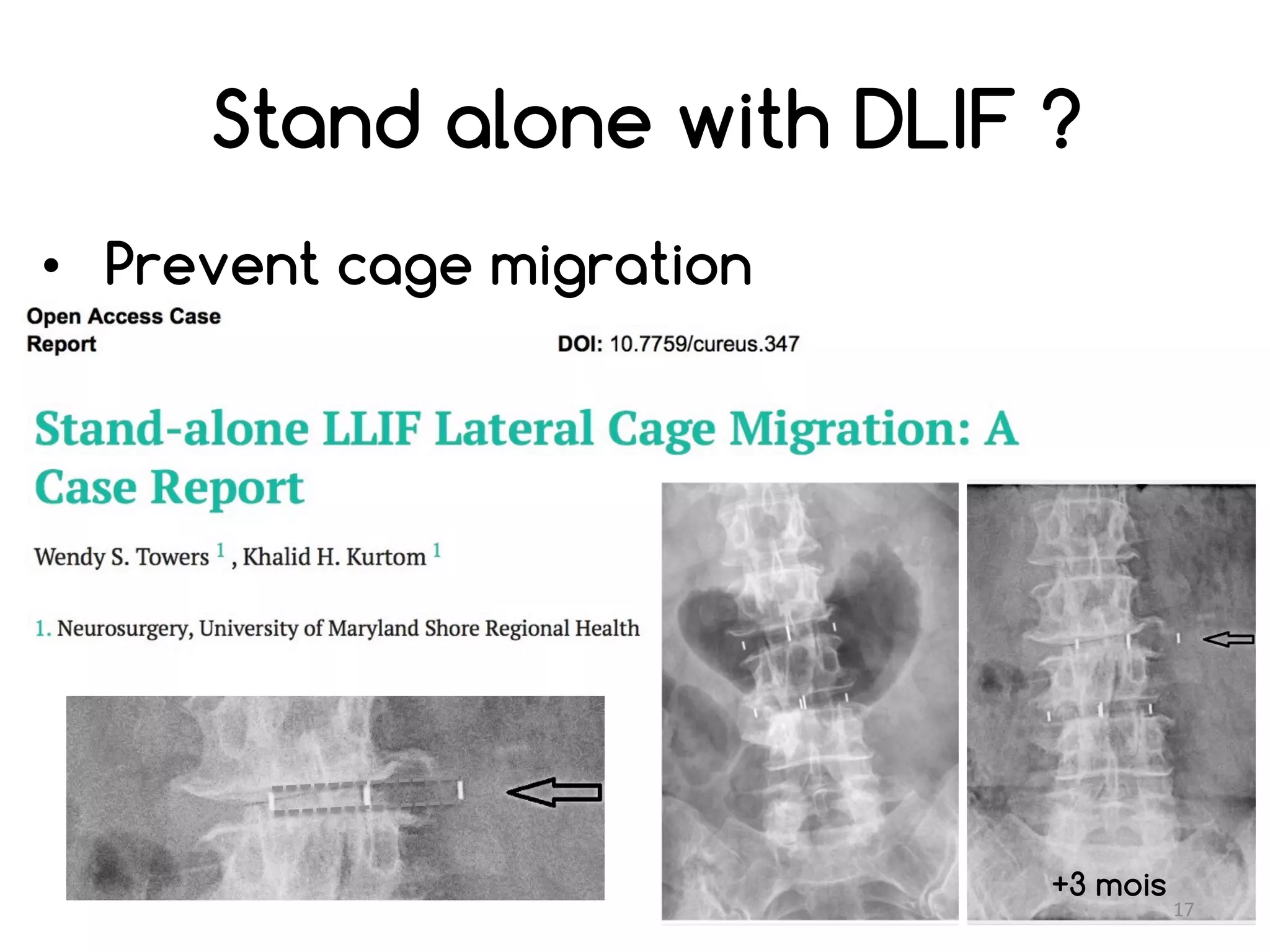 Lateral Lumbar Interbody Fusion : DLIF, XLIF with Lateral Fixation in ...