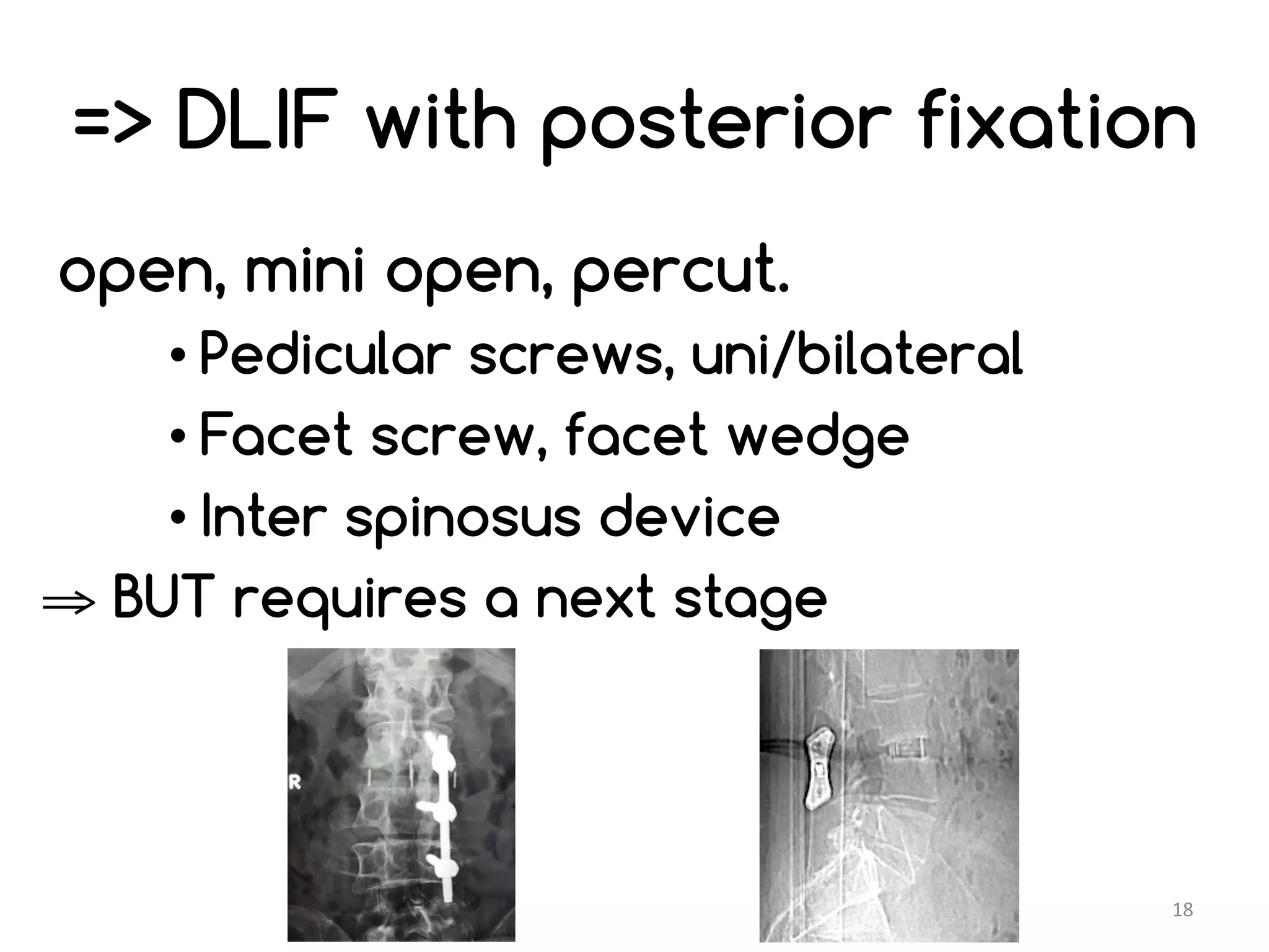 Lateral Lumbar Interbody Fusion : DLIF, XLIF with Lateral Fixation in ...