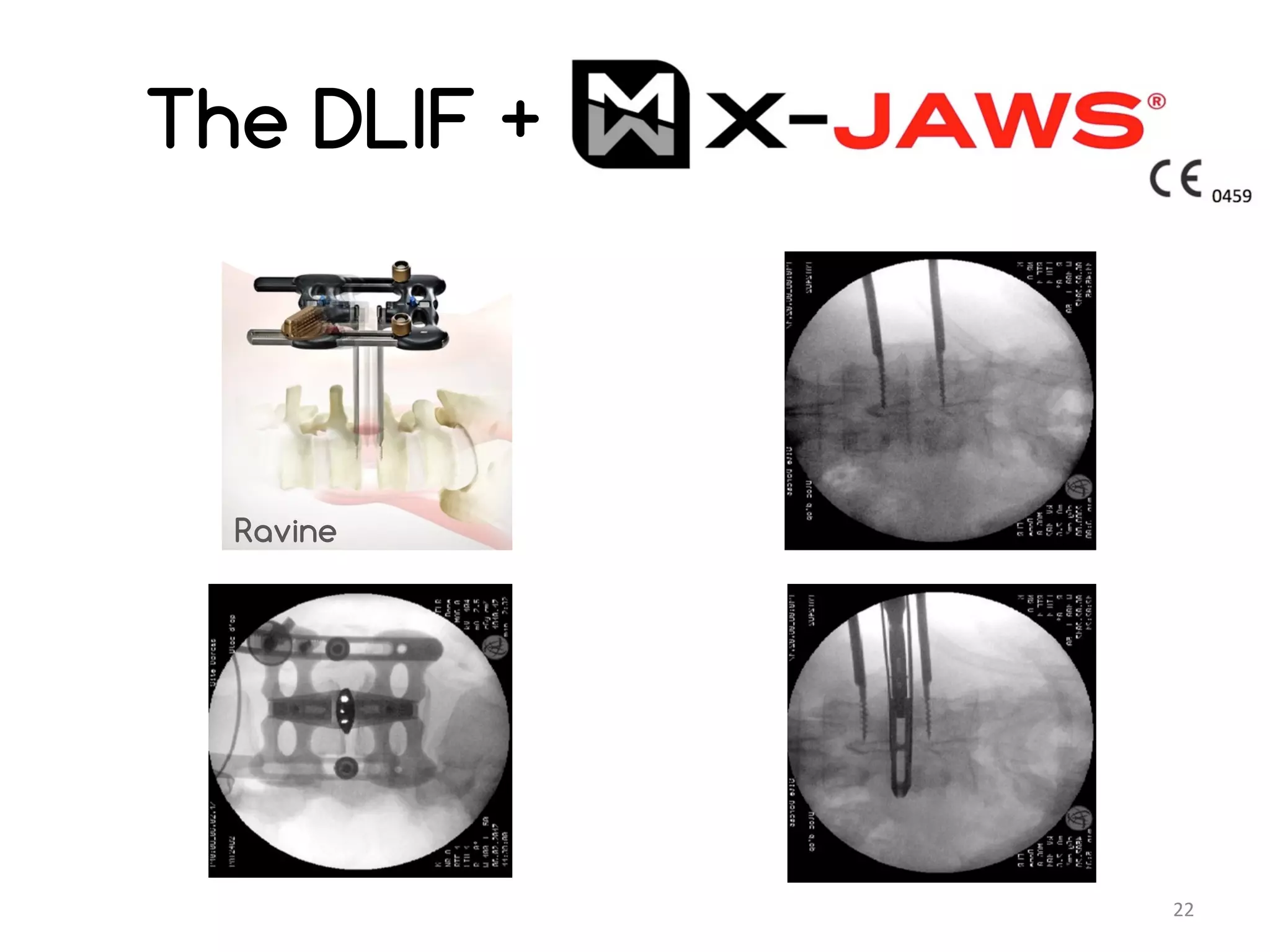 Lateral Lumbar Interbody Fusion : DLIF, XLIF with Lateral Fixation in ...