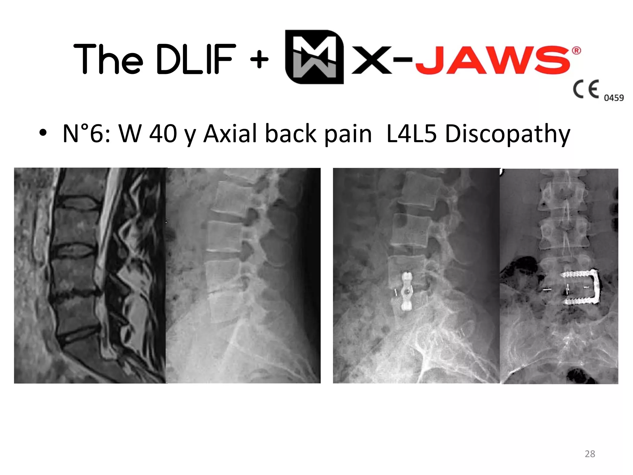 Lateral Lumbar Interbody Fusion : DLIF, XLIF with Lateral Fixation in ...