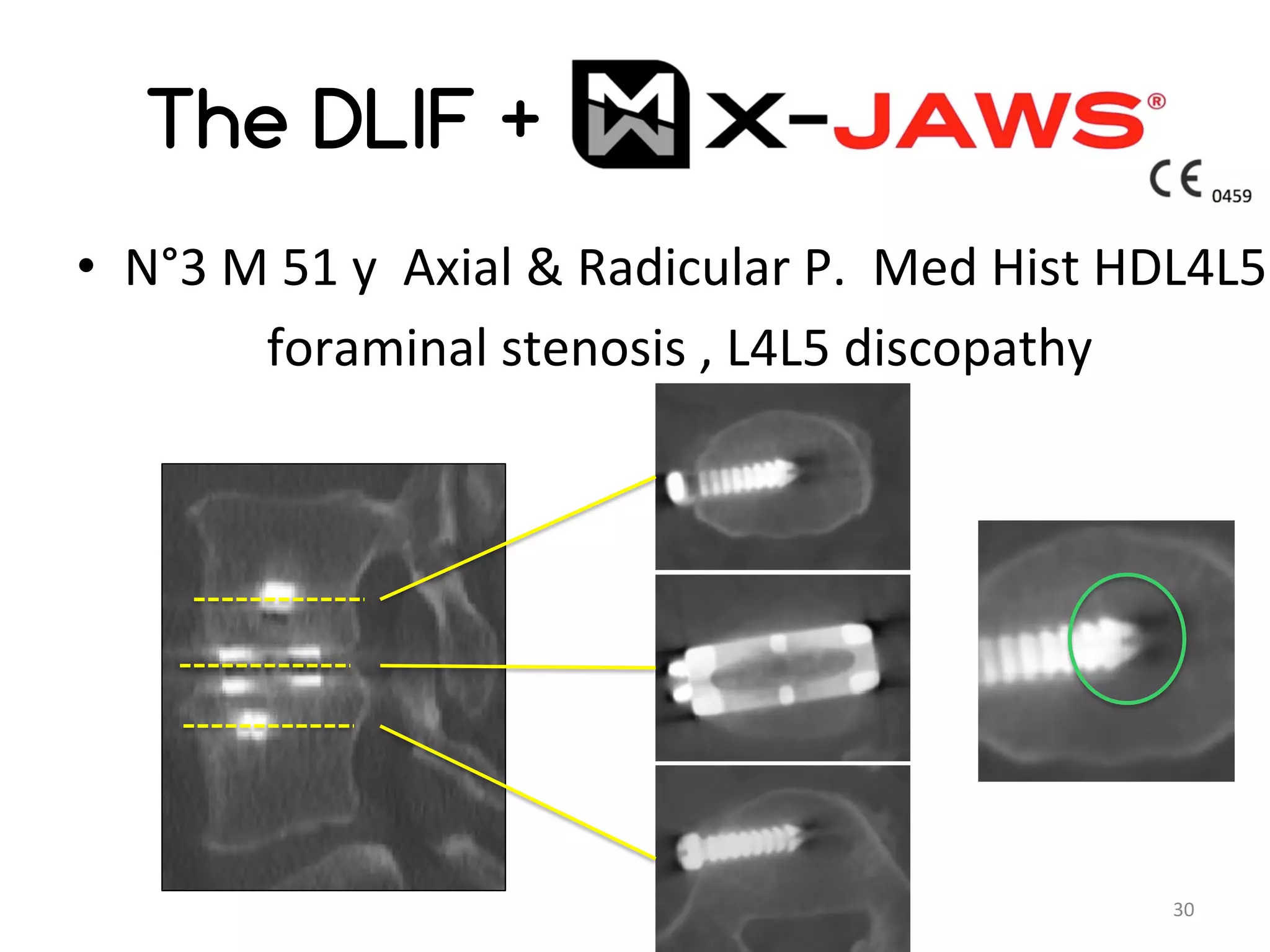 Lateral Lumbar Interbody Fusion : DLIF, XLIF with Lateral Fixation in ...