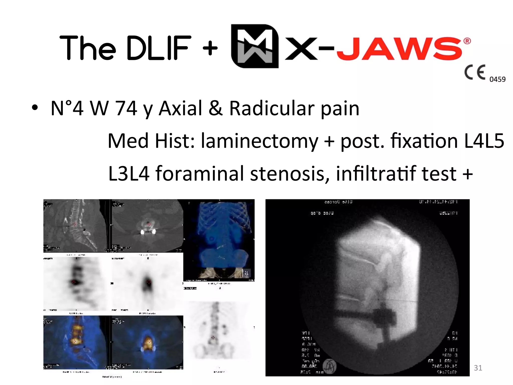 Lateral Lumbar Interbody Fusion : DLIF, XLIF with Lateral Fixation in ...