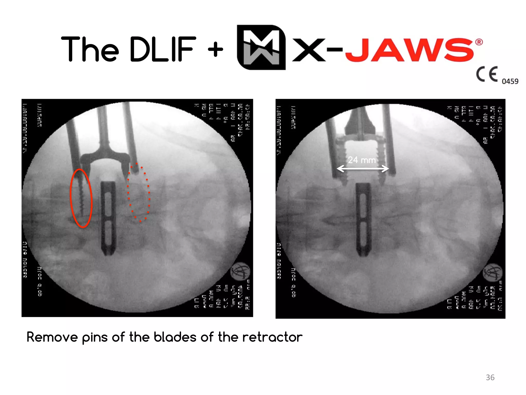 Lateral Lumbar Interbody Fusion : DLIF, XLIF with Lateral Fixation in ...