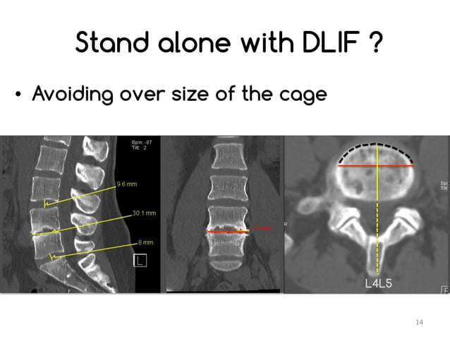 Lateral Lumbar Interbody Fusion : DLIF, XLIF with Lateral Fixation in ...