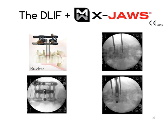 Lateral Lumbar Interbody Fusion : DLIF, XLIF with Lateral Fixation in ...