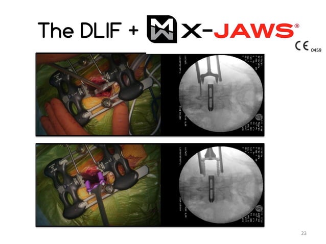Lateral Lumbar Interbody Fusion : DLIF, XLIF with Lateral Fixation in ...