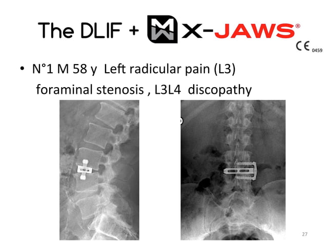 Lateral Lumbar Interbody Fusion : DLIF, XLIF with Lateral Fixation in ...