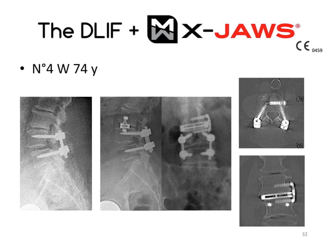 Lateral Lumbar Interbody Fusion : DLIF, XLIF with Lateral Fixation in ...