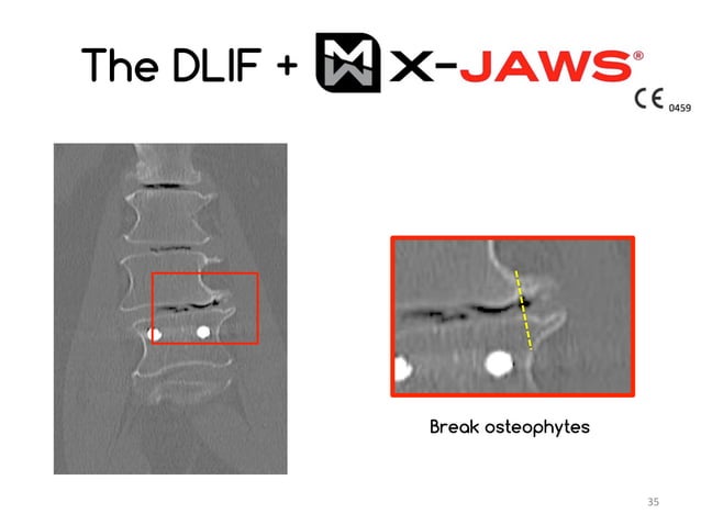 Lateral Lumbar Interbody Fusion : DLIF, XLIF with Lateral Fixation in ...
