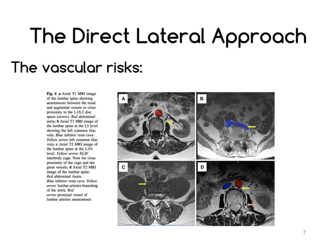 Lateral Lumbar Interbody Fusion : DLIF, XLIF with Lateral Fixation in ...