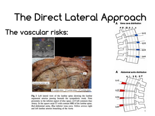 Lateral Lumbar Interbody Fusion : DLIF, XLIF with Lateral Fixation in ...