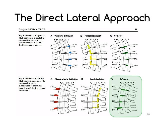 Lateral Lumbar Interbody Fusion : DLIF, XLIF with Lateral Fixation in…