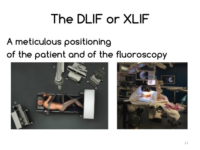 Lateral Lumbar Interbody Fusion : DLIF, XLIF with Lateral Fixation in…