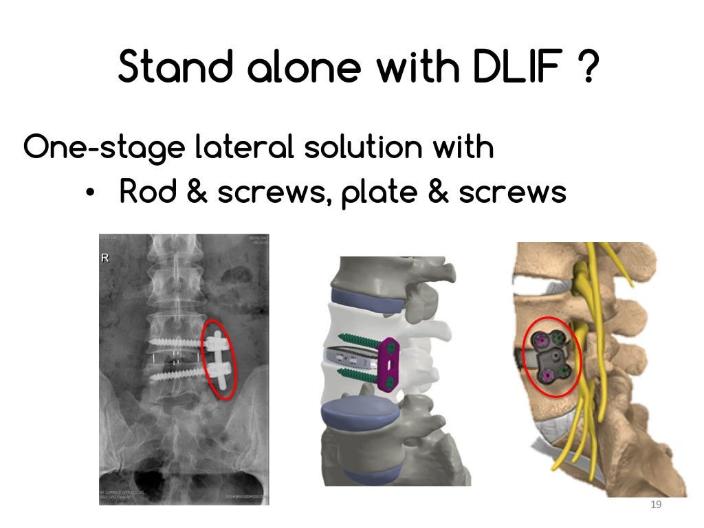 Lateral Lumbar Interbody Fusion : DLIF, XLIF with Lateral Fixation in…