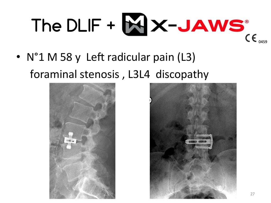 Lateral Lumbar Interbody Fusion : DLIF, XLIF with Lateral Fixation in…