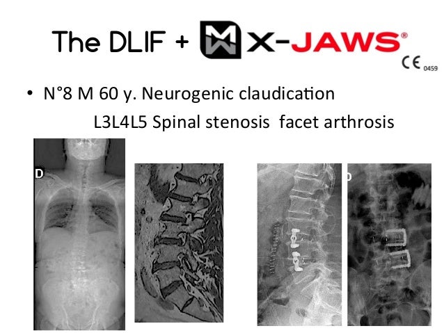 Lateral Lumbar Interbody Fusion : DLIF, XLIF with Lateral Fixation in…