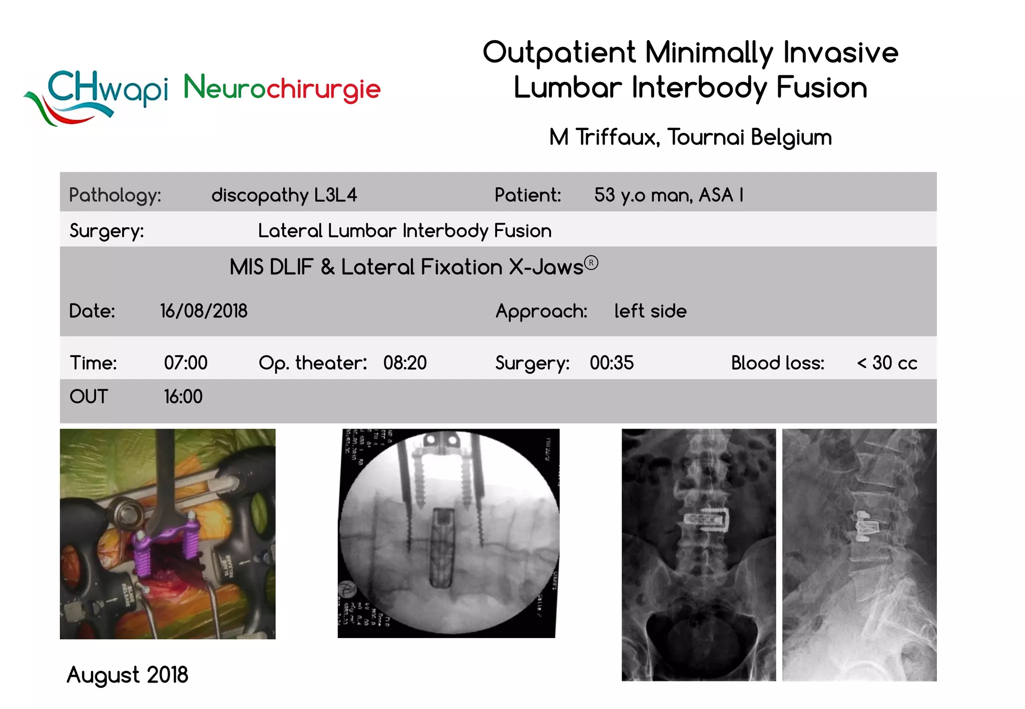 Outpatient Minimally Invasive Lumbar Interbody Fusion DLIF X Jaws | PPT