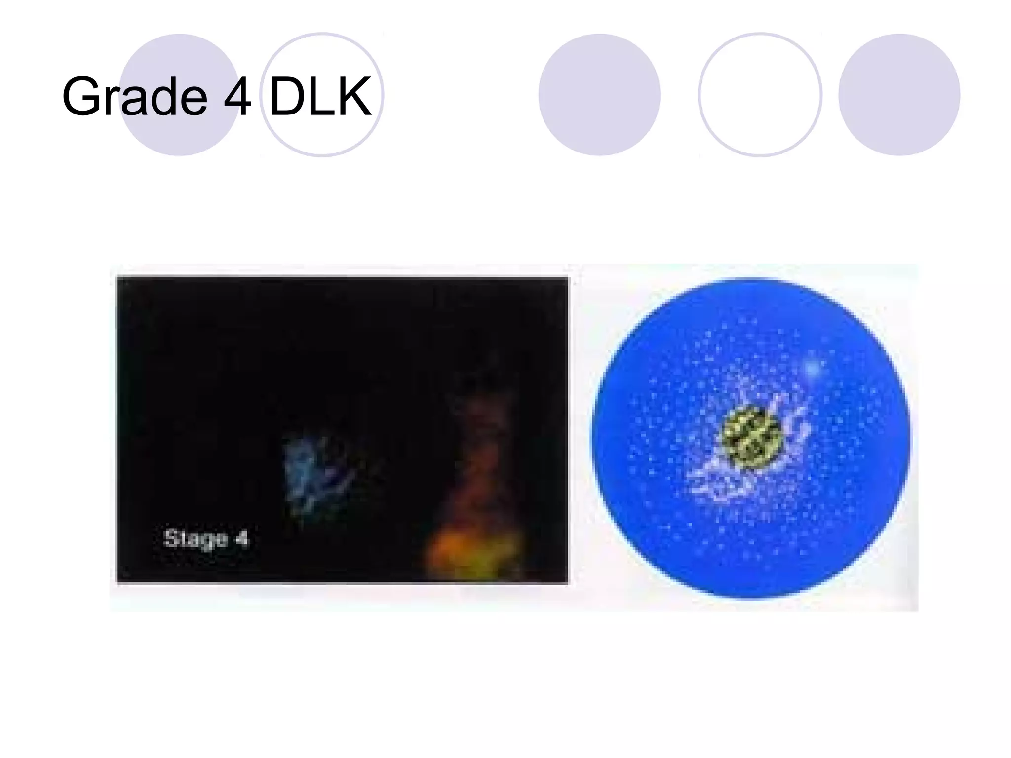 Dlk, Diffuse Lamellar Keratitis after lasik | PPT | Eye and Vision ...