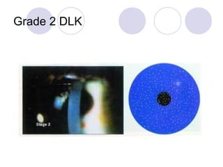 Dlk, Diffuse Lamellar Keratitis after lasik | PPT | Eye and Vision ...