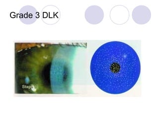 Dlk, Diffuse Lamellar Keratitis after lasik | PPT | Eye and Vision ...