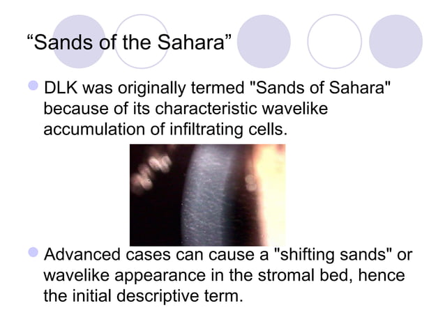 Dlk, Diffuse Lamellar Keratitis after lasik | PPT