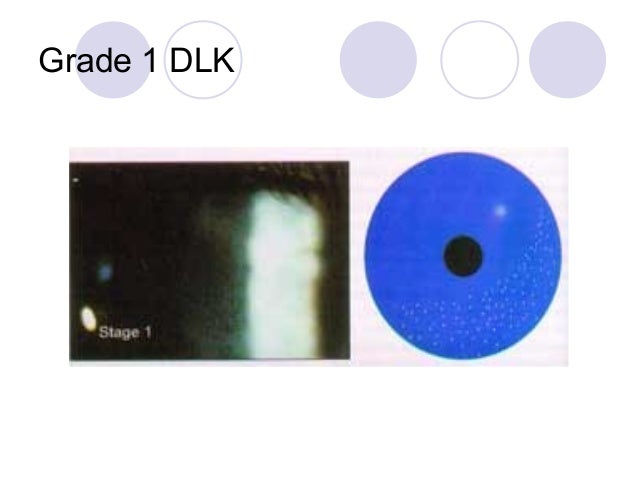 Dlk, Diffuse Lamellar Keratitis after lasik