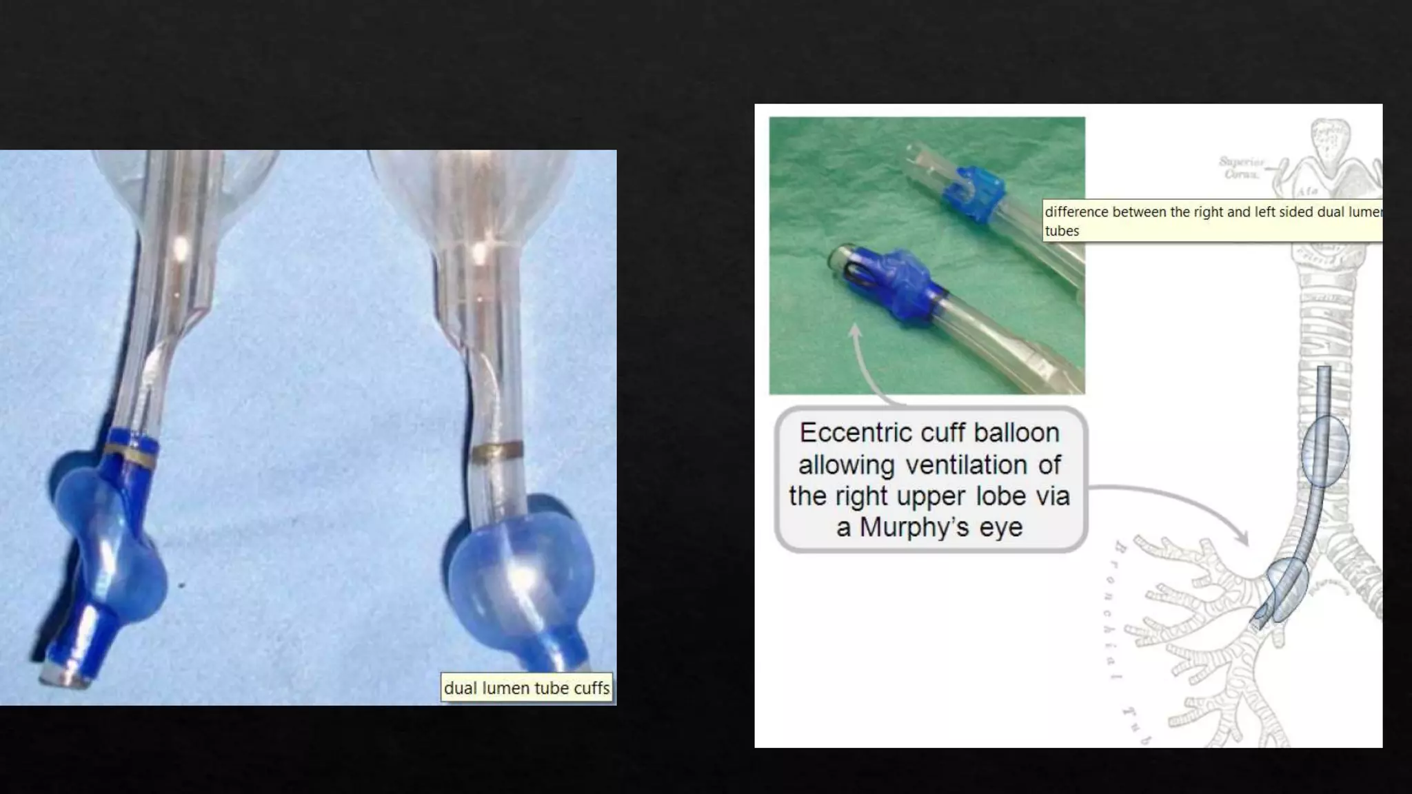 Double Lumen Tubes | PPTX