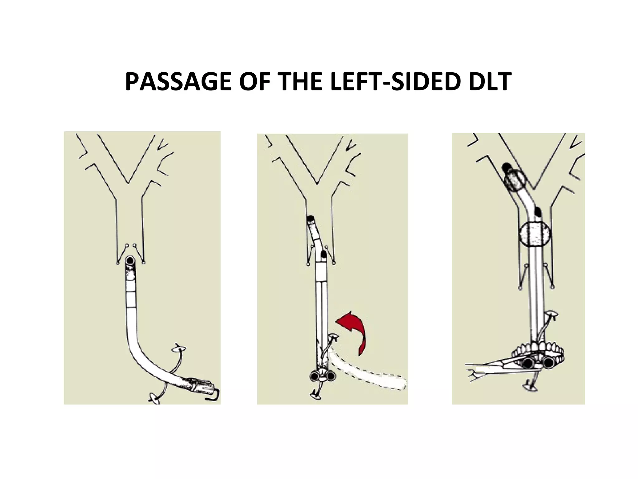 Double Lumen Endobronchial Tubes ppt | PPT