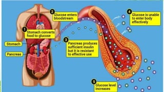 DIABETES MELLITUS ANATOMY and physiology slideshare | PPTX