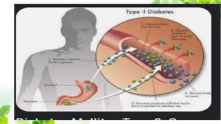 DIABETES MELLITUS ANATOMY and physiology slideshare | PPTX