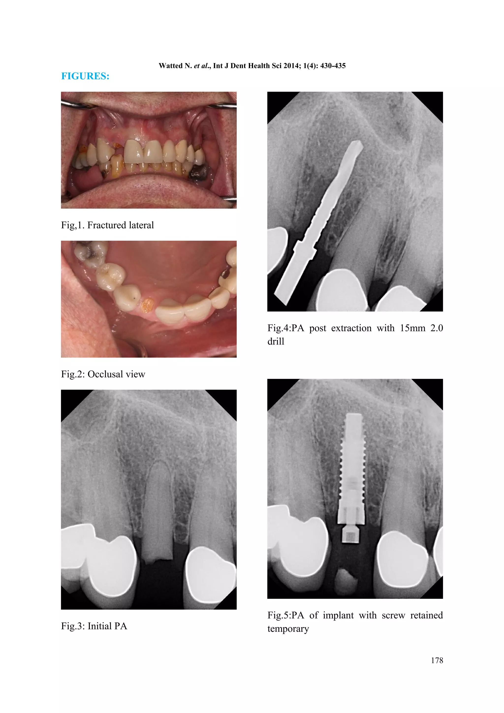 EXTRACTION,IMMEDIATE IMPLANT-A CASE REPORT | PDF