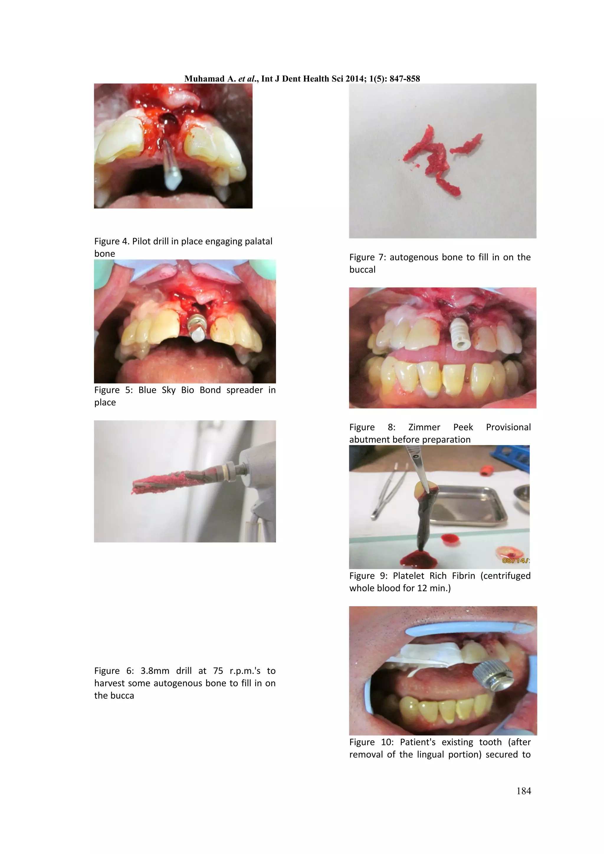 EXTRACTION AND IMMEDIATE IMPLANT PLACEMENT USING A COMBINED PRF, AND PROVISIONALIZATION ...