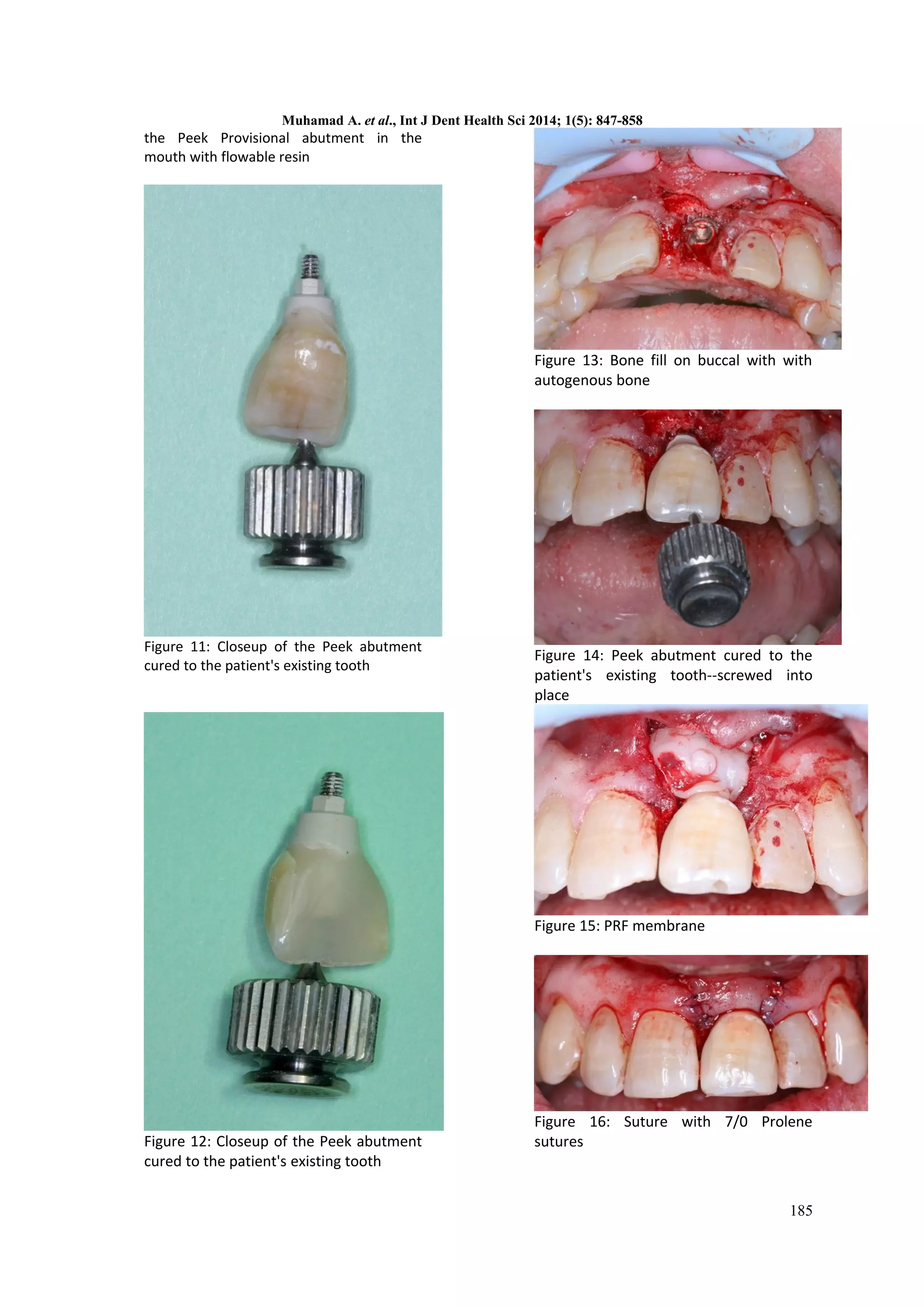EXTRACTION AND IMMEDIATE IMPLANT PLACEMENT USING A COMBINED PRF, AND PROVISIONALIZATION ...