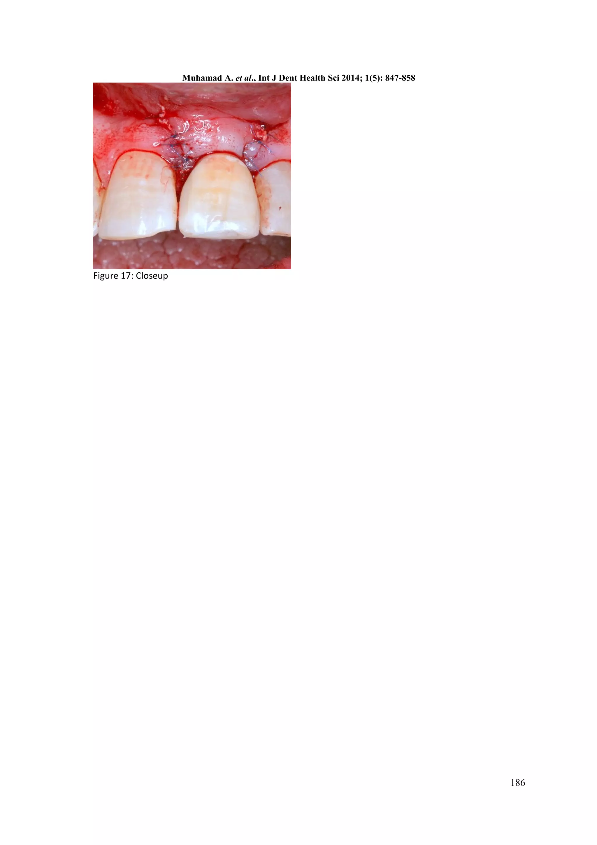 EXTRACTION AND IMMEDIATE IMPLANT PLACEMENT USING A COMBINED PRF, AND PROVISIONALIZATION ...