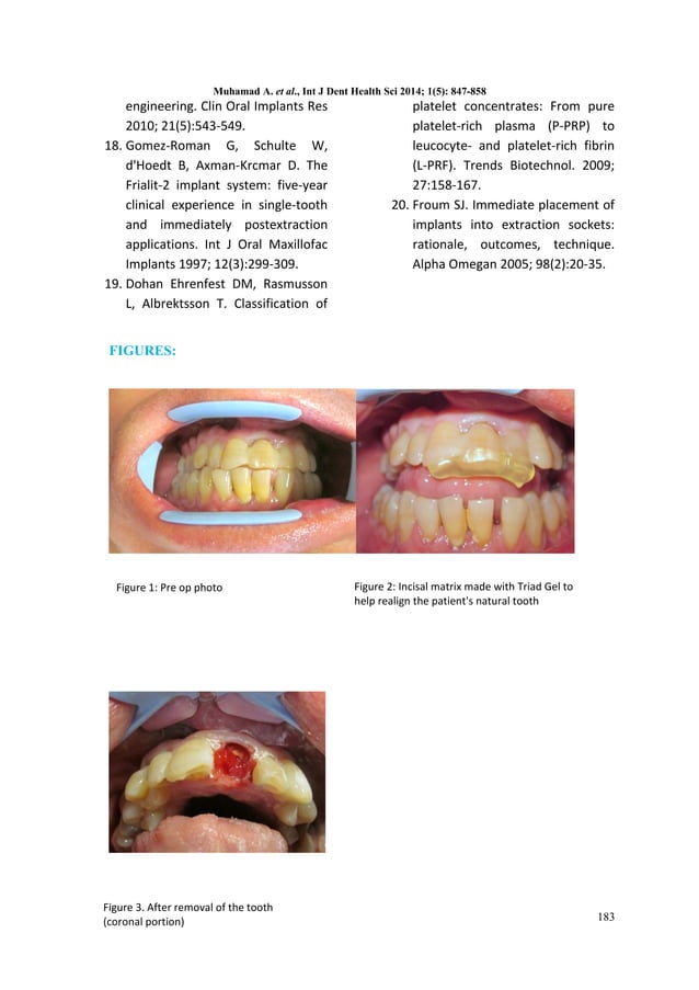 EXTRACTION AND IMMEDIATE IMPLANT PLACEMENT USING A COMBINED PRF, AND PROVISIONALIZATION ...