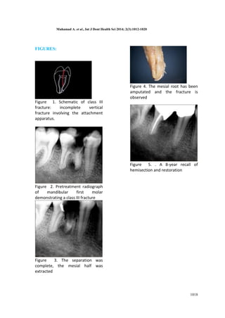 HEMISECTION: A CONSERVATIVE APPROACH FOR FURCATION-INVOLVED MANDIBULAR ...
