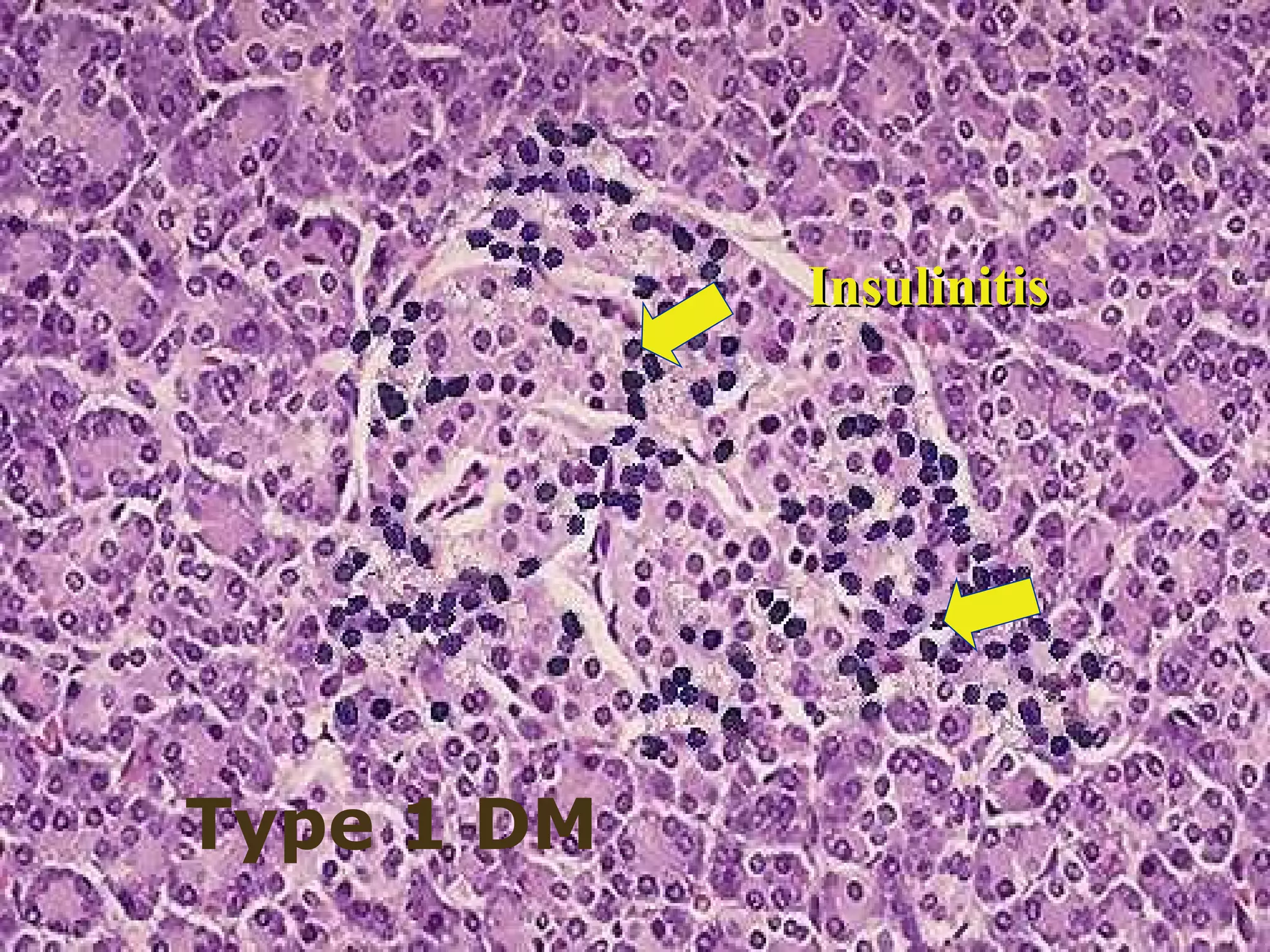 pathophysiology of DM1 | PPT