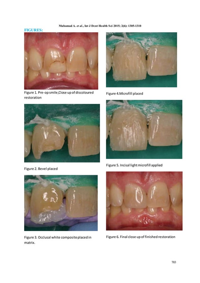 Step-by-Step Approaches for Anterior Direct Restorative | DOCX