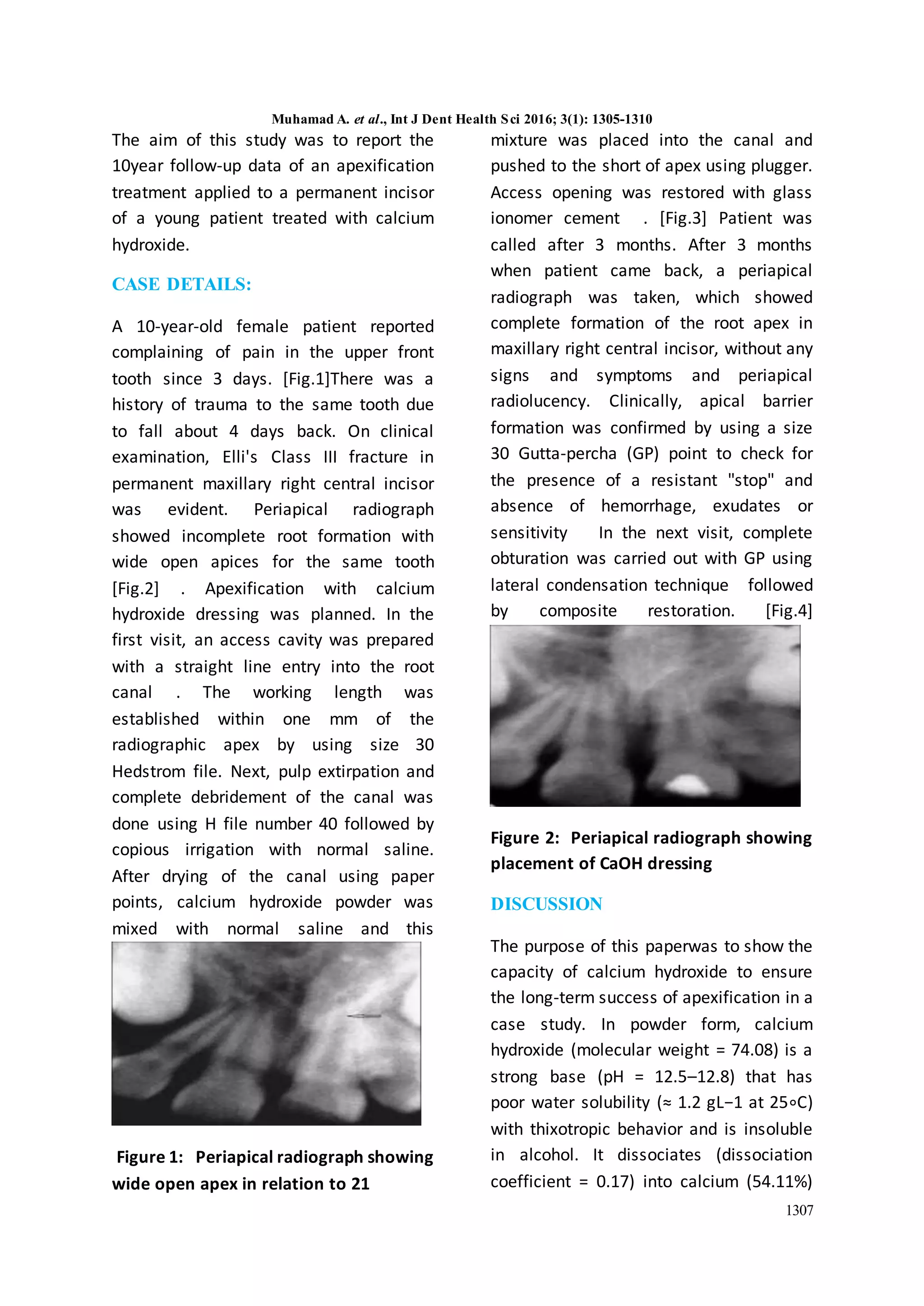 MANAGEMENT OF OPEN APEX IN PERMANENT TEETH WITH CALCIUM HYDROXIDE PASTE ...