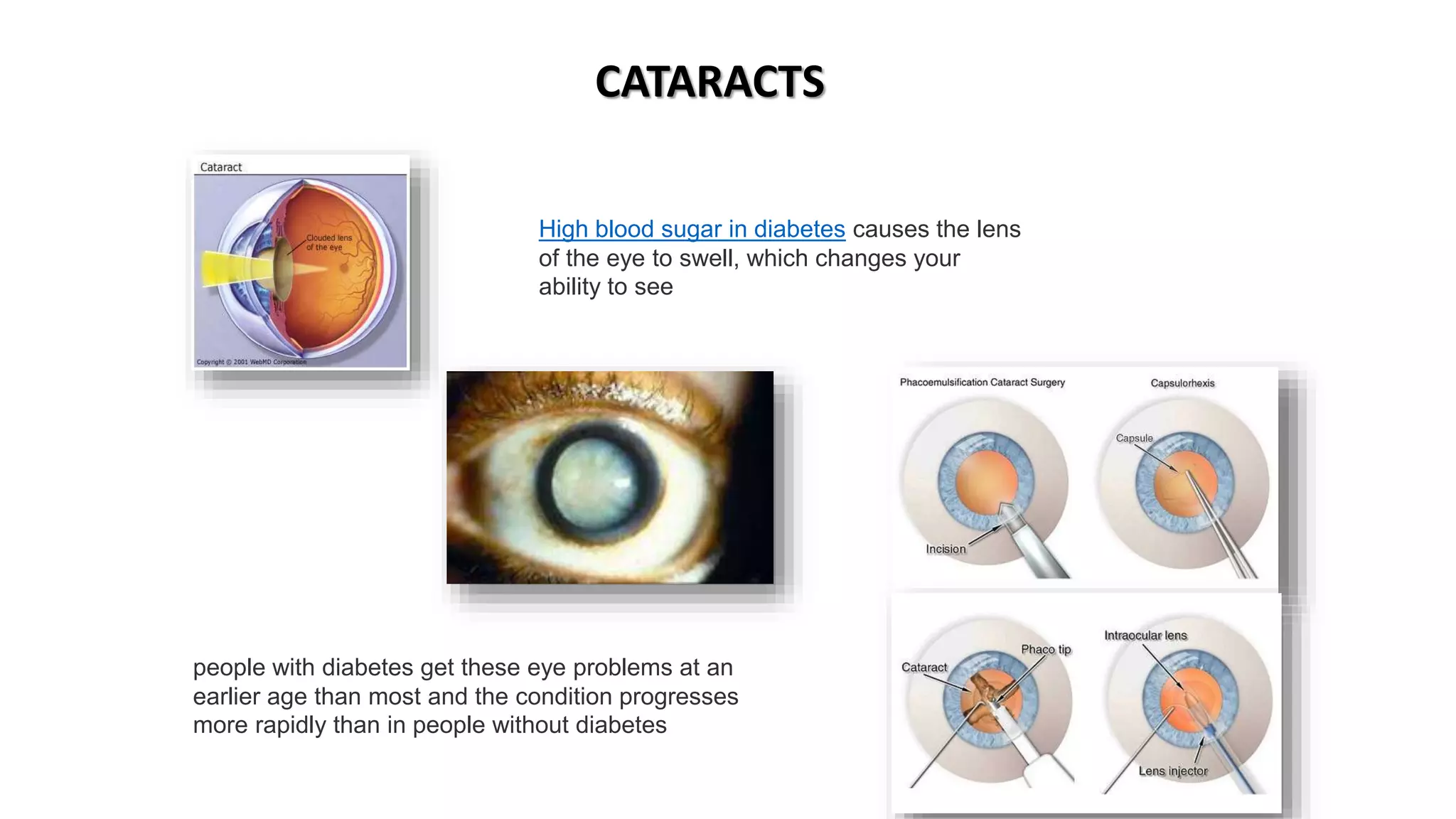 Dm cataract glaucoma | PPTX